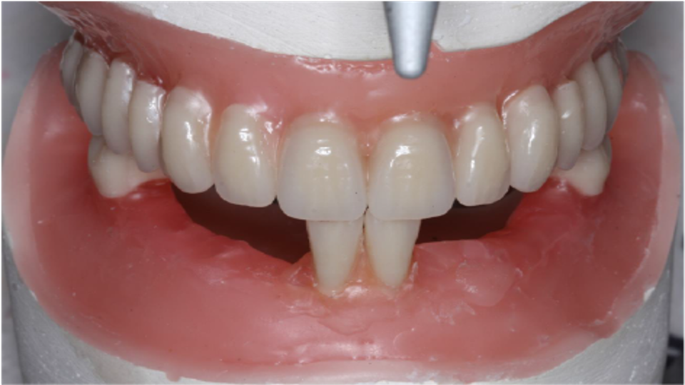 Caso Clínico: Montaje de dientes para prótesis completa