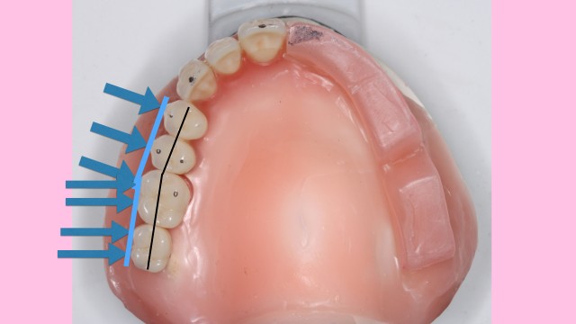 Caso Clínico: Montaje de dientes para prótesis completa